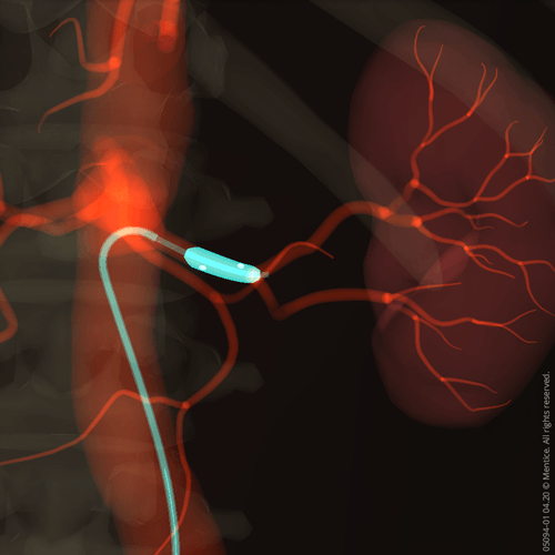 Renal Denervation | Software | Mentice
